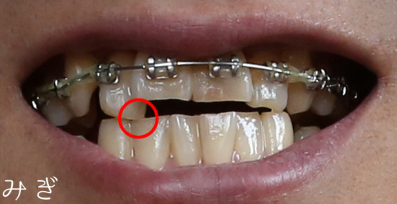 歯列矯正（12回目）〜奥歯で物が噛めなくて辛い〜 - 7thwheel blog