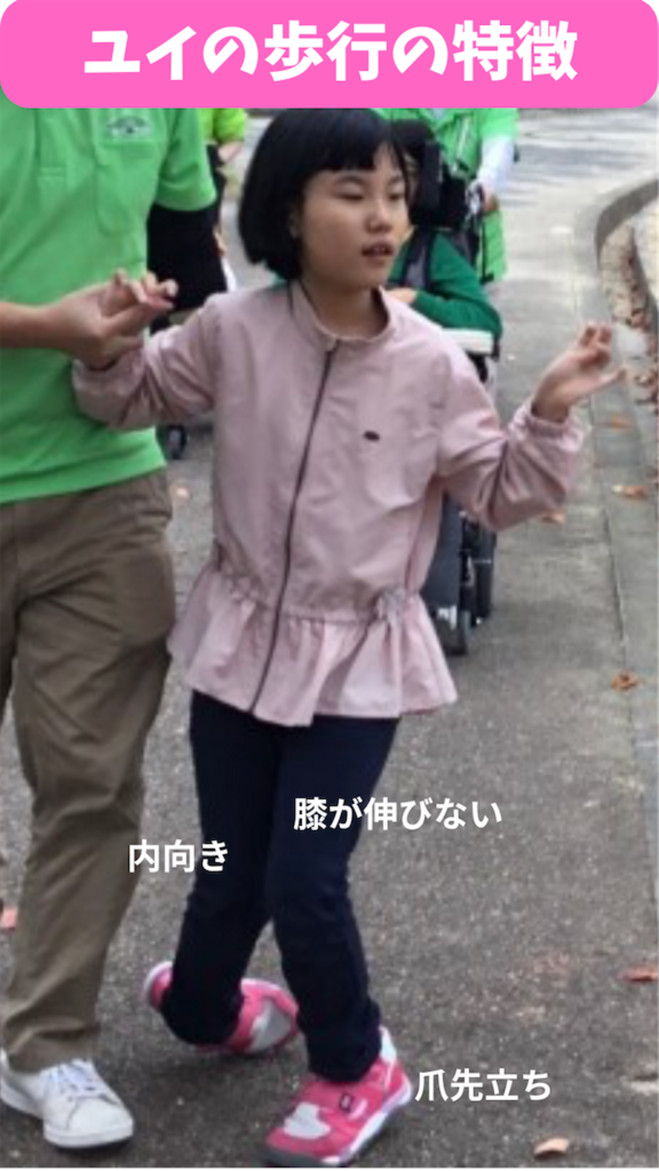 ユイの今の歩き方の特徴について - 娘。唯とのリハビリ記録